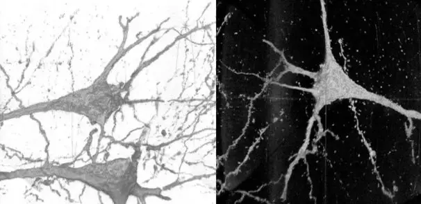 In die brein van mense met skisofrenie opgemerk ongewone neurone