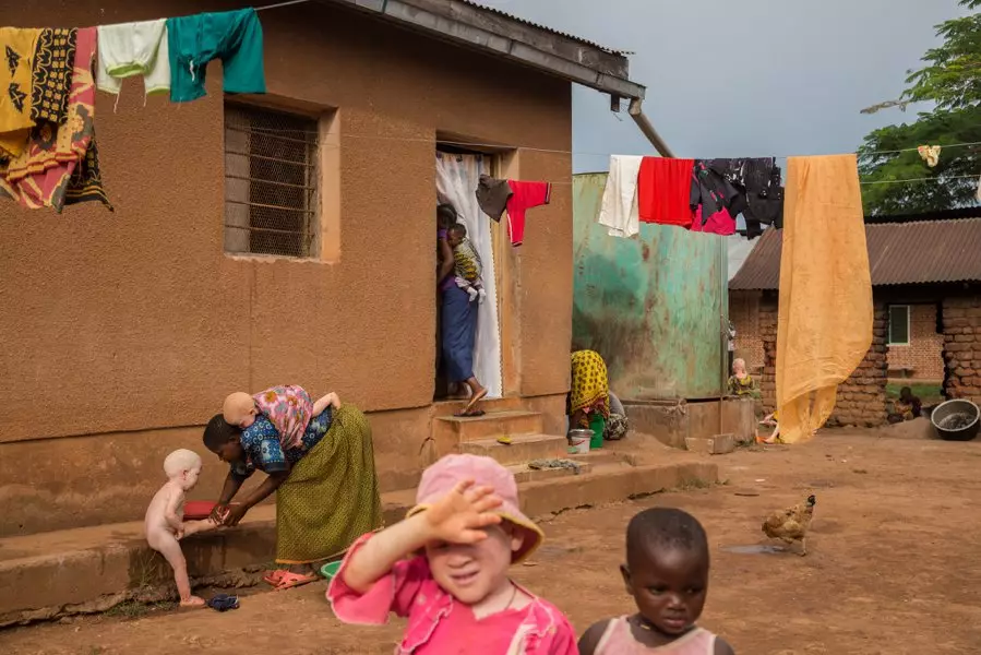 Albinos: la vie dans la peur