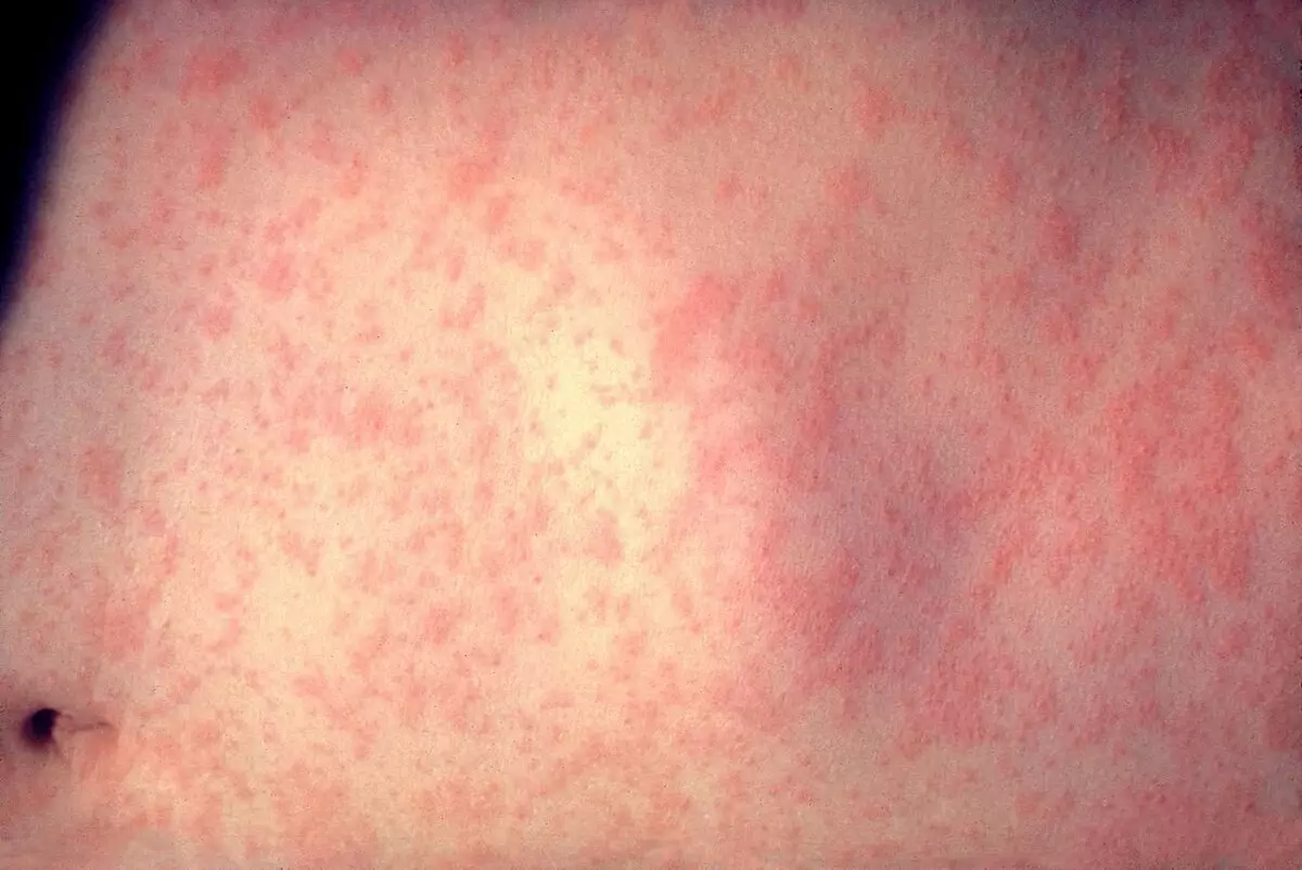 1280px-morbillivirus_measles_infection.jpg।