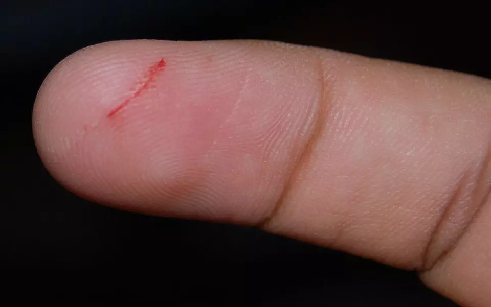 Pse prerja e gishtit nga letra shkakton dhimbje të tilla të rënda?