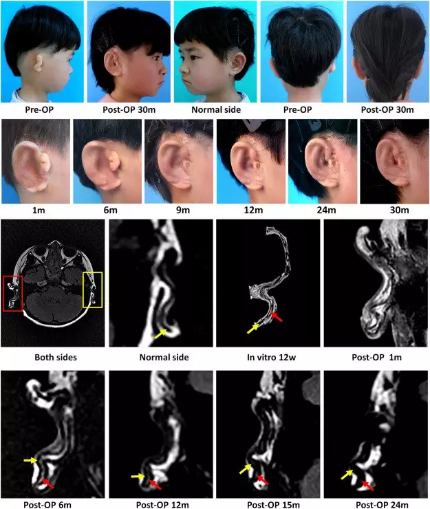 Bern dy't earen oerplante hawwe printe op in 3D-printer