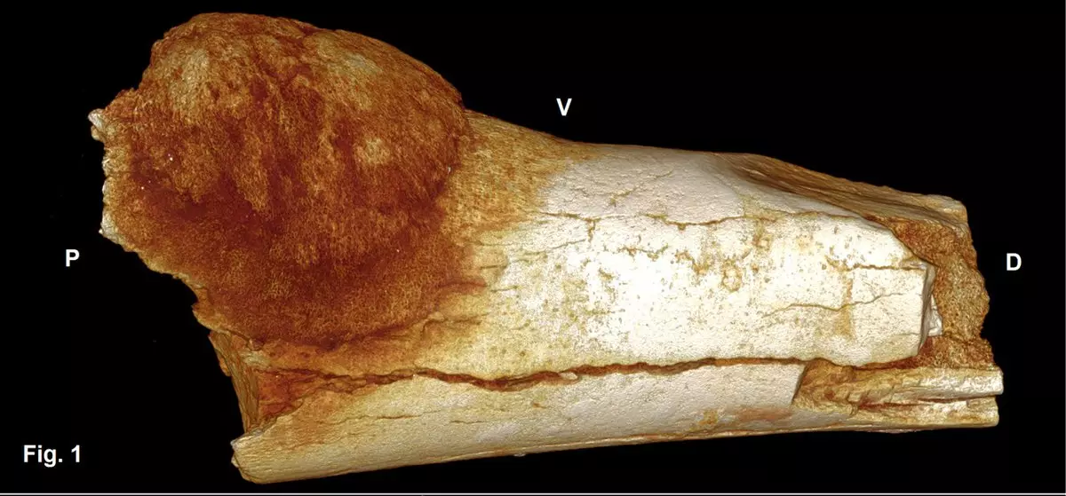 Forskere har funnet en kreftvulst i beinet på 1,7 millioner år
