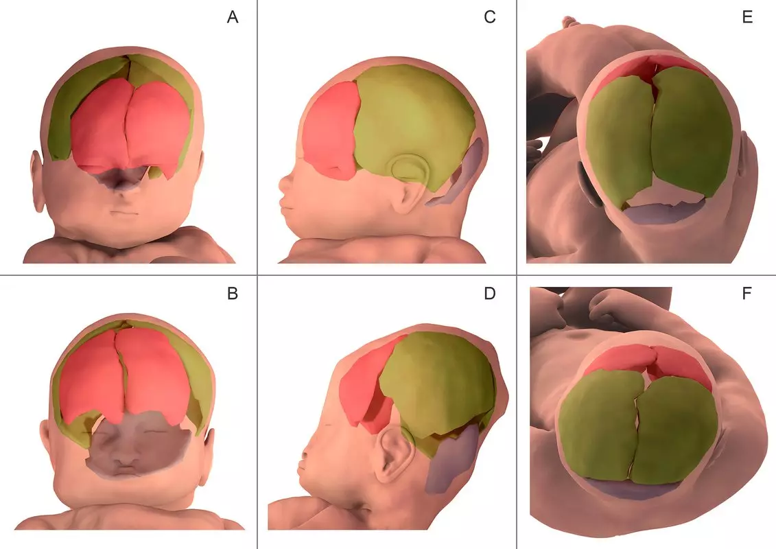 Hoe het hoofd van een kind verandert tijdens de bevalling: een nieuwe studie