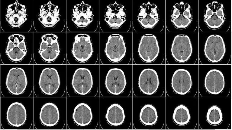 I-Medical Penomenon: Umuntu waphila iminyaka engama-60 + ephethe i-hemisphere eyodwa yobuchopho