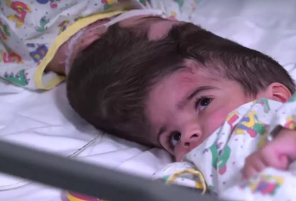 Лекарите ги поделија кревките глави на сијамски близнаци