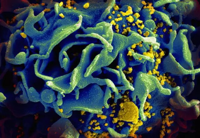 For første gang i 19 år ble en ny HIV-stamme oppdaget