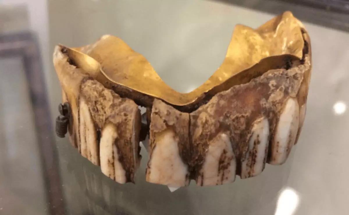 Briton trovò una mascella di inserto in oro e ossa