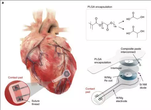 Létrehozott egy vezeték nélküli pacemaker
