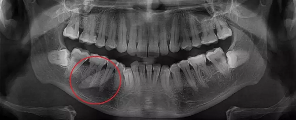 Ang mga dentista ay nagkakamali na tinanggap ang bato ng mga duct ng salivary para sa ngipin