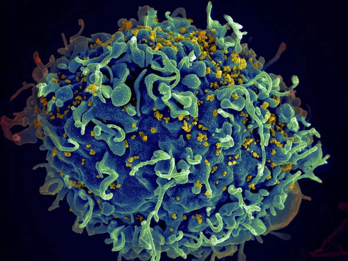 تاریخ میں دوسرا مریض مکمل طور پر ایچ آئی وی سے علاج کرتا ہے