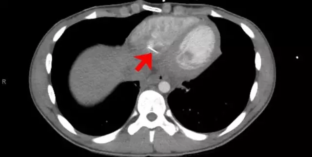 Булавка застрягла в серці підлітка з США після того, як він випадково проковтнув її